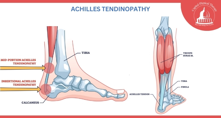 Achilles Tendinopathy vs. Tendonitis: What’s The Difference And How ...